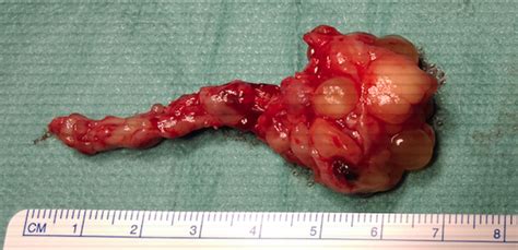 Most Important Resected Polyp With Osseous Metaplasia Download