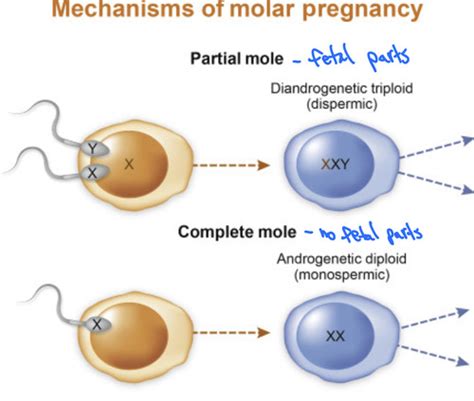 Gestational Trophoblastic Neoplasia Flashcards Quizlet