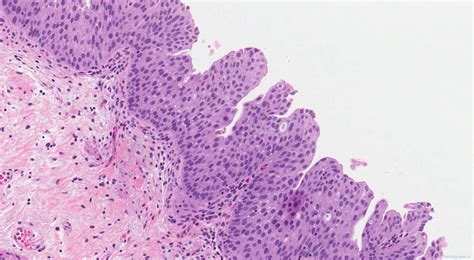 Bladder Cancer Archives Ottawa Atlas Of Pathology