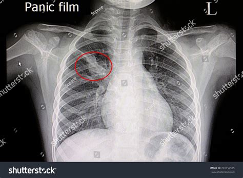 Chest X Ray Pneumonia Vs Atelectasis At Van Flores Blog