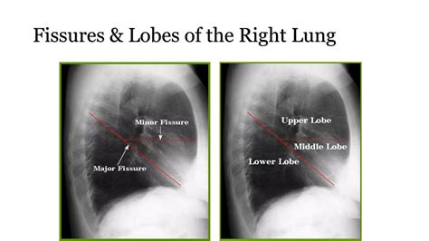 Lung Cancer Anatomy To Pathological Classification Pptx