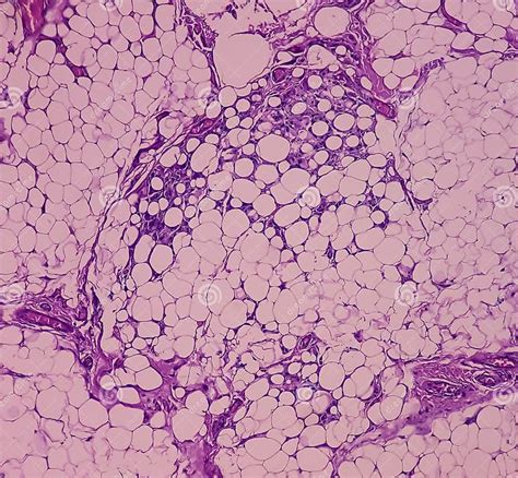 Lipoma On Cubital Fossa Benign Growth Of Fatty Tissue Benign Neoplasm