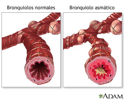 Bronquiolo Normal Vs Bronquiolo Asmático Medlineplus Enciclopedia