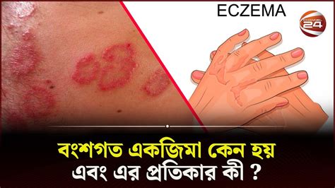 বংশগত একজিমা কেন হয় এবং এর প্রতিকার কী Health Tips Skin Care