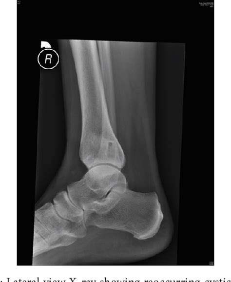 Figure 3 From Intraosseous Ganglion Of The Distal Tibia Clinical Radiological And Operative