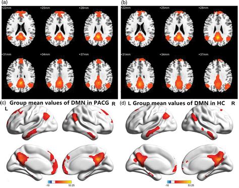 Altered Functional Connectivity Between The Default Mode Net