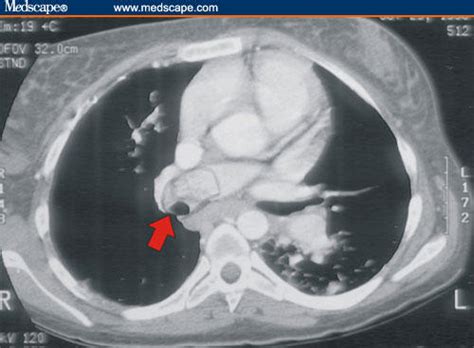 Thromboendarterectomy As Treatment In The Antiphospholipid Syndrome Pmc