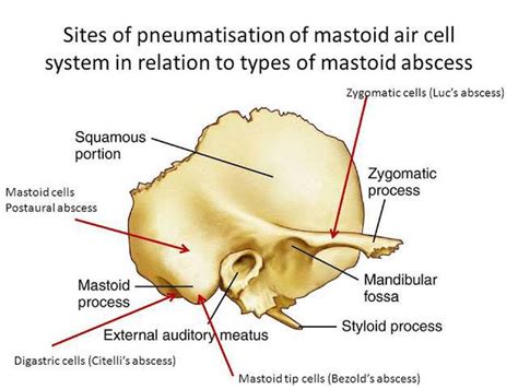 Types Of Mastoid Abcesses Medizzy
