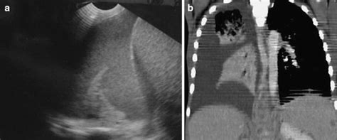 Tuberculosis Radiology Key