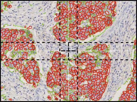 Imploying TS To Detect Epithelial Area And Using DL Model Using U Net Architecture To Detect