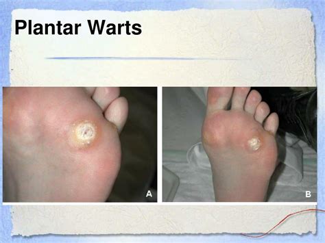 Ppt Chapter 34 Warts Revised 81510 Powerpoint Presentation Free