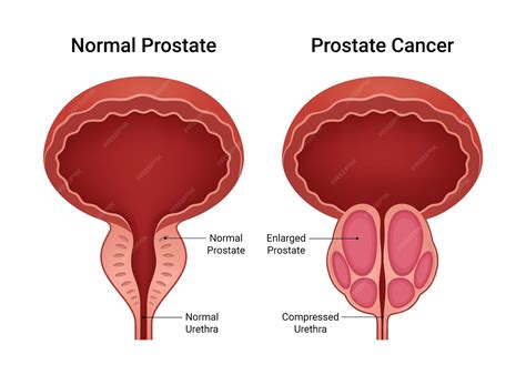 Premium Vector Normal Prostate And Prostate Cancer Inflammation