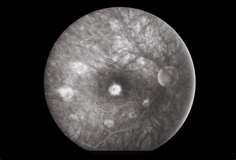 Decreased Visual Acuity Case 2 Retina Image Bank