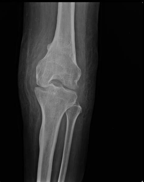 Xray Tech Times Patella Fracture Xray Tech X Ray