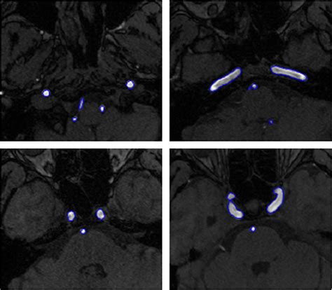 Some 2d Slices Of The Segmentation Result On Cerebral Mra Dataset Using Download Scientific
