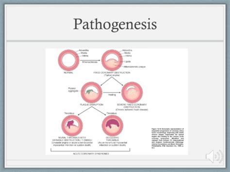 Cvs 2 Myocardial Pathology Flashcards Quizlet