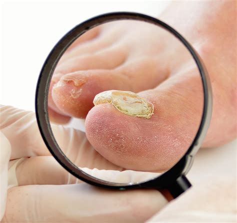 Лечение на Онихомикоза гъбички по ноктите Diona Pro