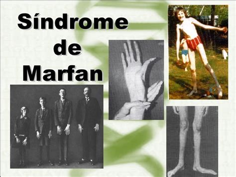 Síndrome De Marfan