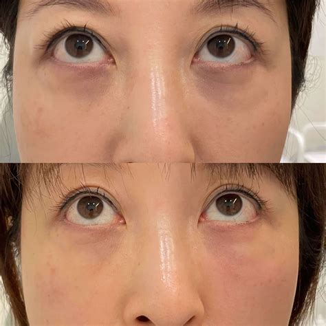 Injections And Fillers The Grand Medical Aesthetic Clinic