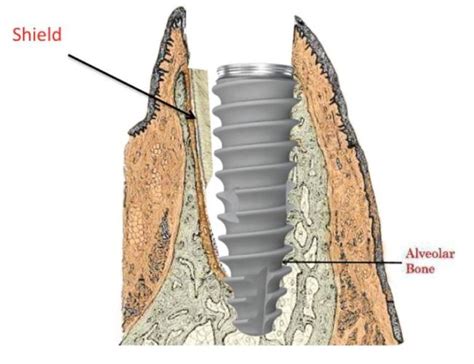 Socket Shield Ace Achievers