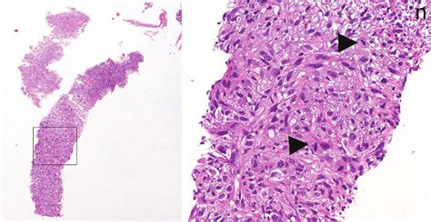 Lung Biopsy Showing A Poorly Differentiated Neoplasm Solid In