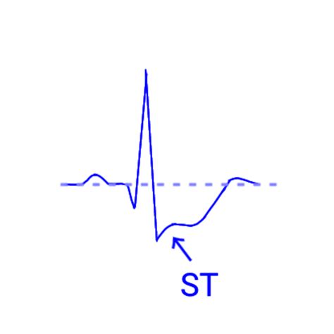 わかりやすい心電図の説明 ⑪st低下 Stが低下する疾患 狭心症 医師の心電図ブログ