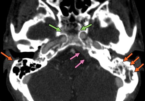 Osteomyelitis Of Skull Radiology At Phillip Hayes Blog