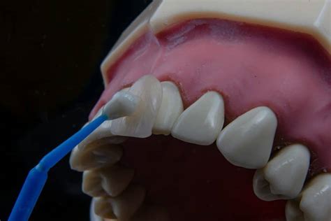 Composite Veneers Murdoch Dental And Implant Centre