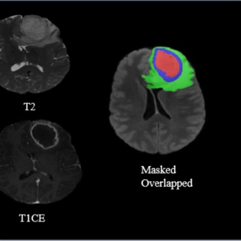 Multi Parametric MR Scans T1 T2 FLAIR T1 GD With Whole Tumor GBM
