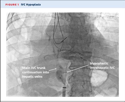 Navigating Complex Anatomy During Leadless Pacemaker Implantation