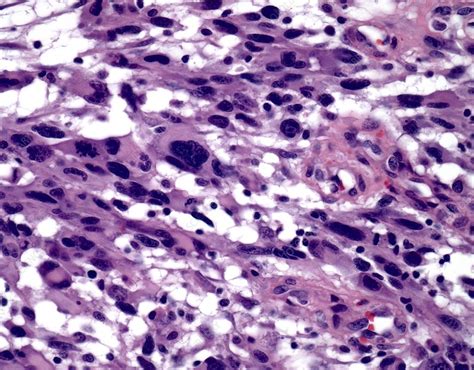 Pleomorphic Rhabdomyosarcoma Light Micrograph Stock Image C049 0445 Science Photo Library