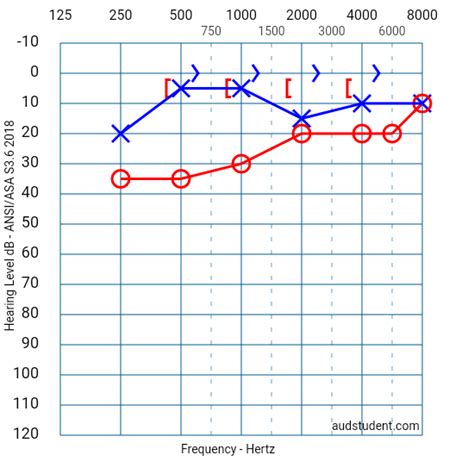 Otitis Media Audiogram Example At Diane Carey Blog