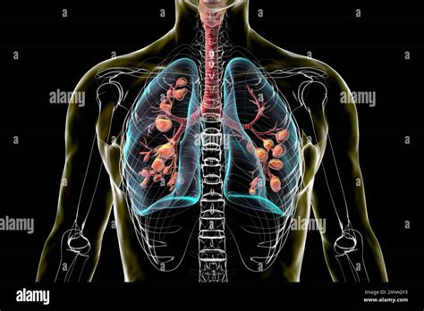 Illustration Of Lungs Affected By Cystic Fibrosis A Genetic Disorder Causing Thick Mucus