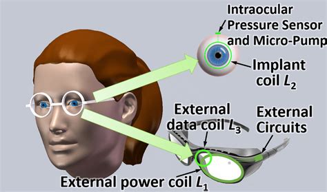Application Scenario Of The Intraocular Sensor System For Glaucoma Download Scientific Diagram