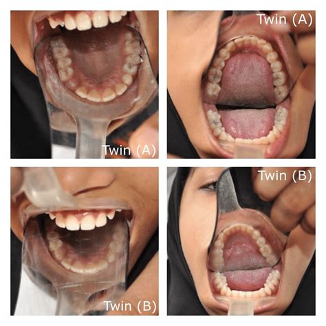 Occlusal Photographs Of Maxillary And Mandibular Arch Of Case Iii