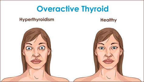 Royalty Free Hyperthyroidism Clip Art Vector Images And Illustrations