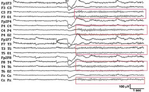 EEG Basics Waveform Morphology
