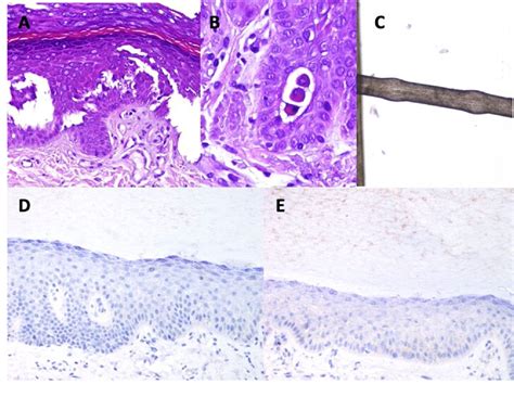 Figure 1 From Heterozygous Arrhythmogenic Cardiomyopathy Desmoplakin Mutation Carriers Exhibit A