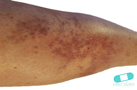 Vasculitis Leukocytoclastic Vasculitis Online Dermatology