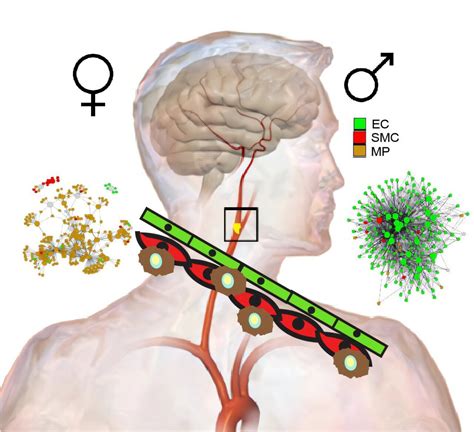Sex Differences In Carotid Artery Plaques And Stroke Symptoms Revealed