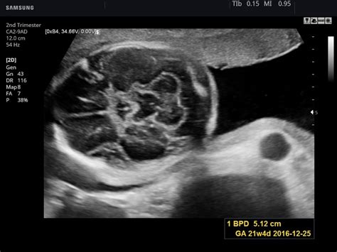 Normal Fetal Brain Ultrasound