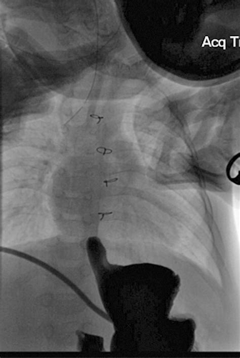 Figure 2 From Laparoscopic Gastric Transposition With Cervical