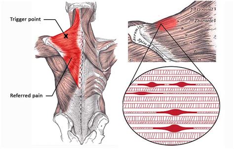 What Cause Fibromyalgia Trigger Points