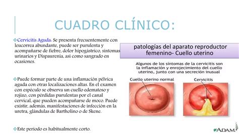 Cervicitis Aguda Y Crónica Ectropion Cervical Ulceracion Erosion Pptx