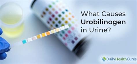 Urobilinogen 10 Possible Causes Diagnosis Treatments And Prevention