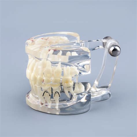 Clear Pathology Teeth Model With Broken Tooth Root And Gum