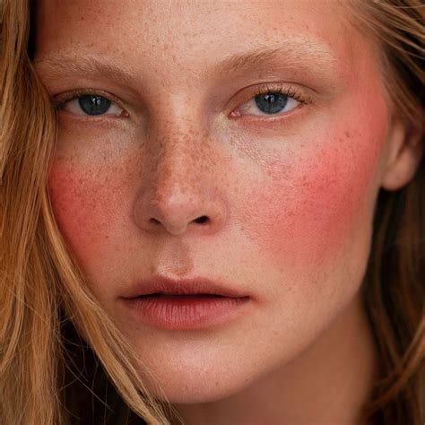5 Golden Rules For Treating Hyperpigmentation Skin Love Cream