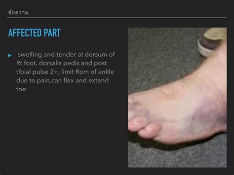 Fifth Metatarsal Bone Fracture Ppt