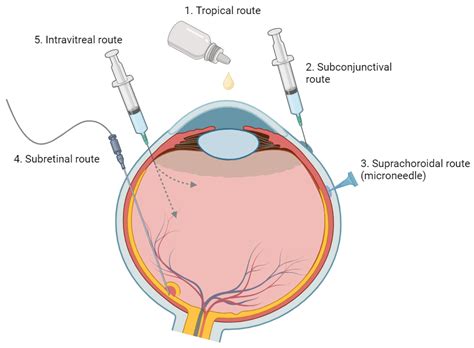 Suprachoroidal Injection A Novel Approach For Targeted Drug Delivery