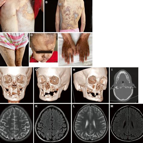 Skin Features And Ectodermal Dysplasia A C The Patient Download
